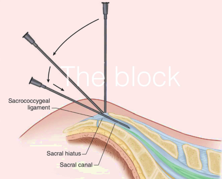 Caudal Block – Spine and Knee Clinic – Official website of Dr.Atul M ...